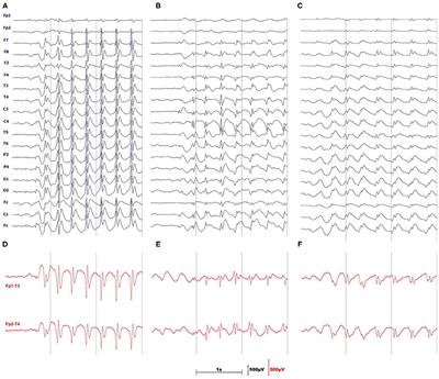 Frontiers | Absence Seizure Detection Algorithm for Portable EEG Devices